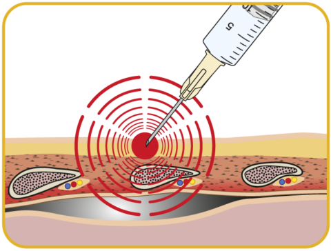 Die korrekte Anlage einer Thoraxdrainage - Vygon