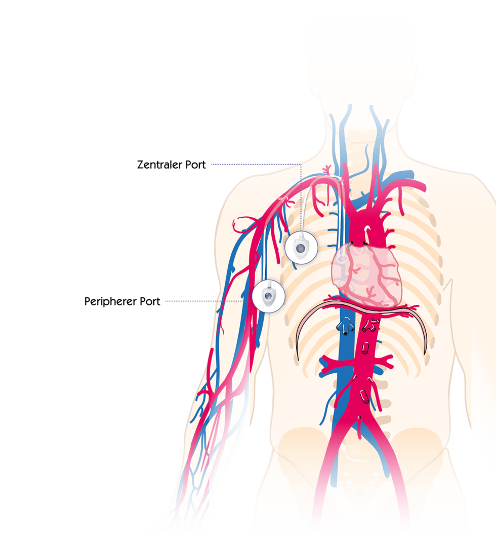 Portkatheter und Portkanülen - Vygon