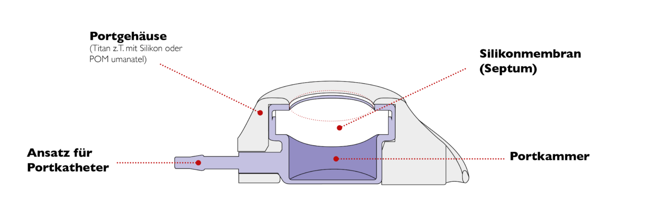 Portkatheter und Portkanülen - Vygon