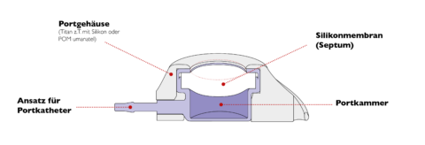 Portkatheter und Portkanülen - Vygon
