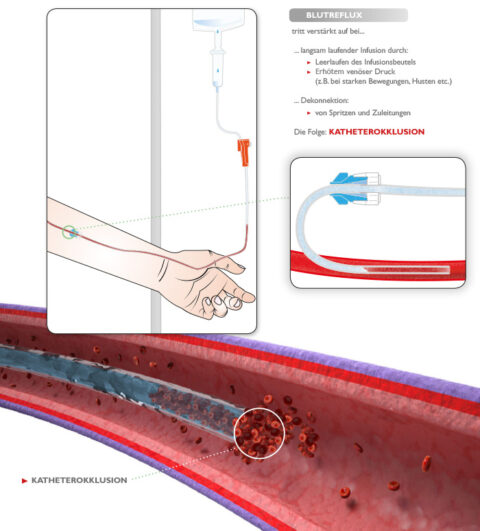 6 SCHLÜSSELASPEKTE ZUR RICHTIGEN HANDHABUNG UND PFLEGE EINES ZVK - Vygon