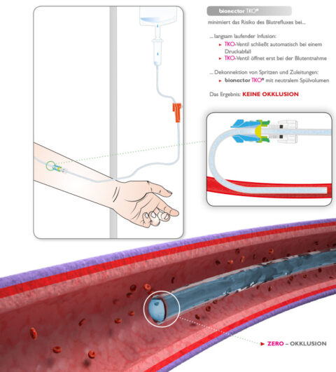 6 SCHLÜSSELASPEKTE ZUR RICHTIGEN HANDHABUNG UND PFLEGE EINES ZVK - Vygon